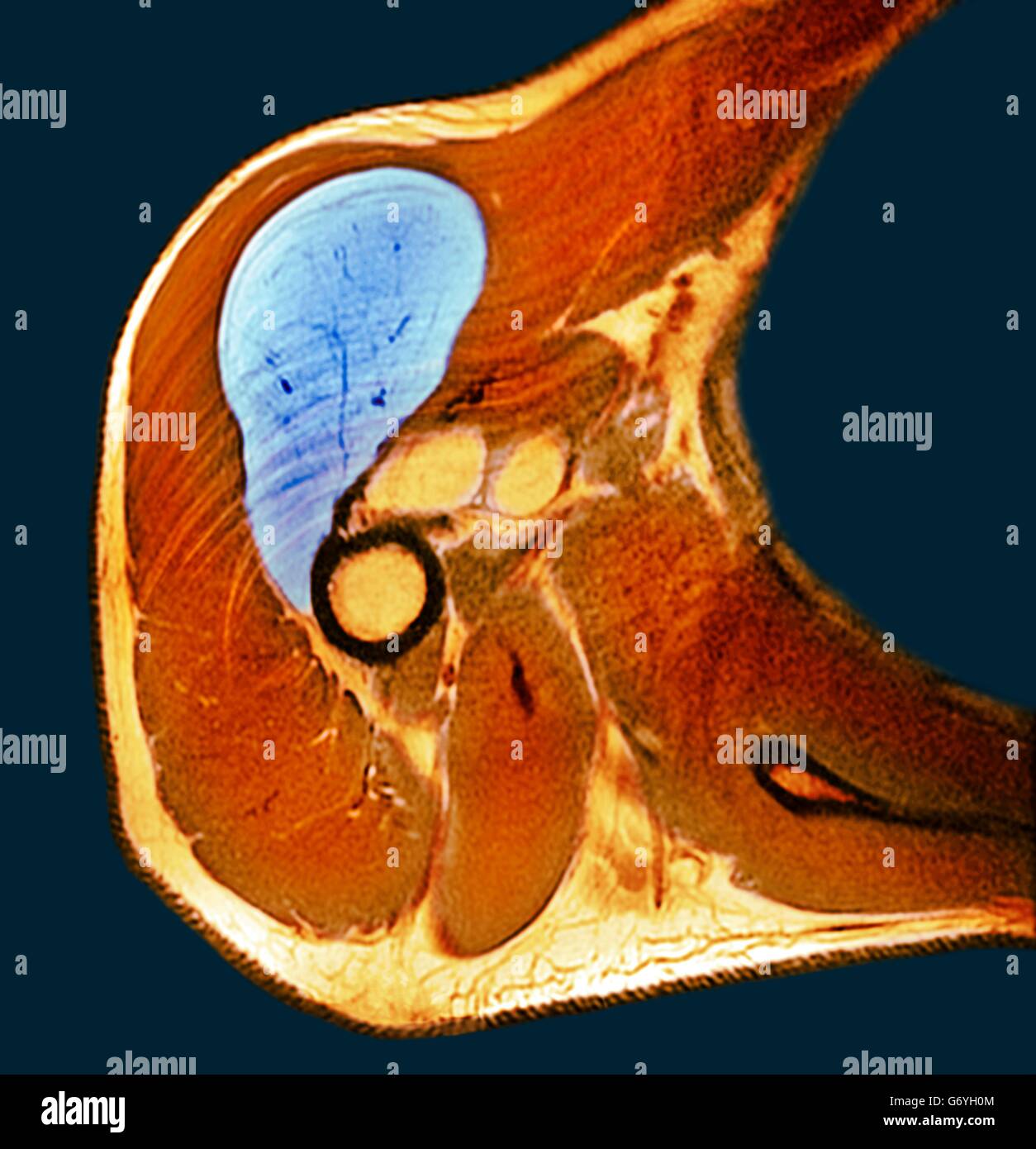 Lipoma hi-res stock photography and images - Alamy