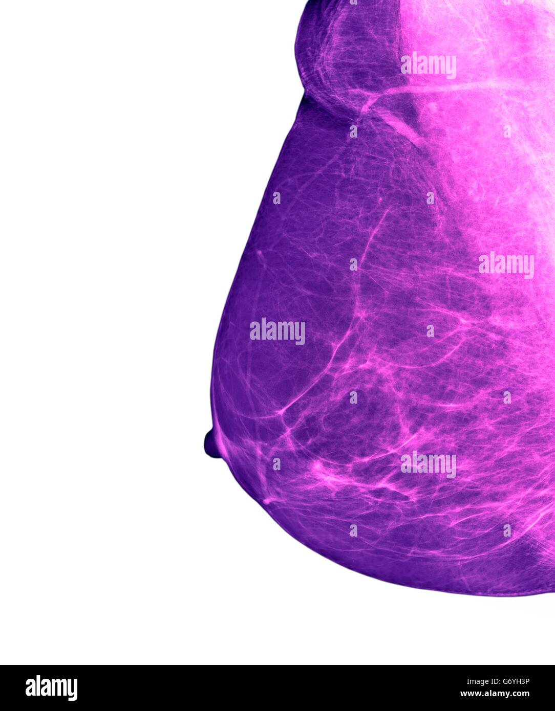 Breast cancer screening. Coloured breast X-ray (mammogram) performed ...
