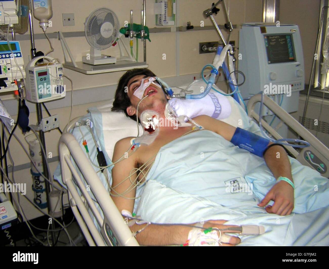 Broken abscess hi-res stock photography and images - Alamy