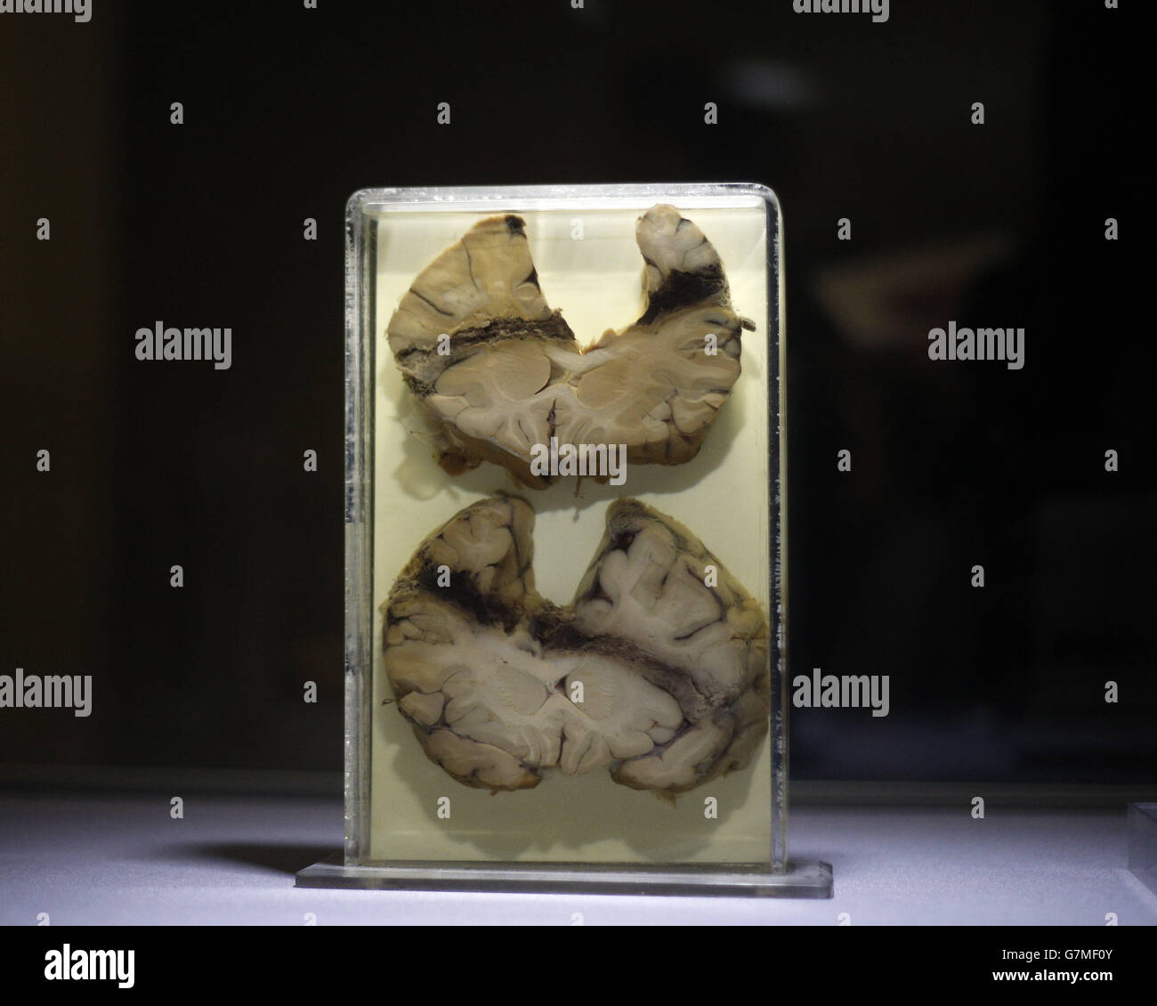 A brain section showing the journey of a bullet in The Wellcome ...