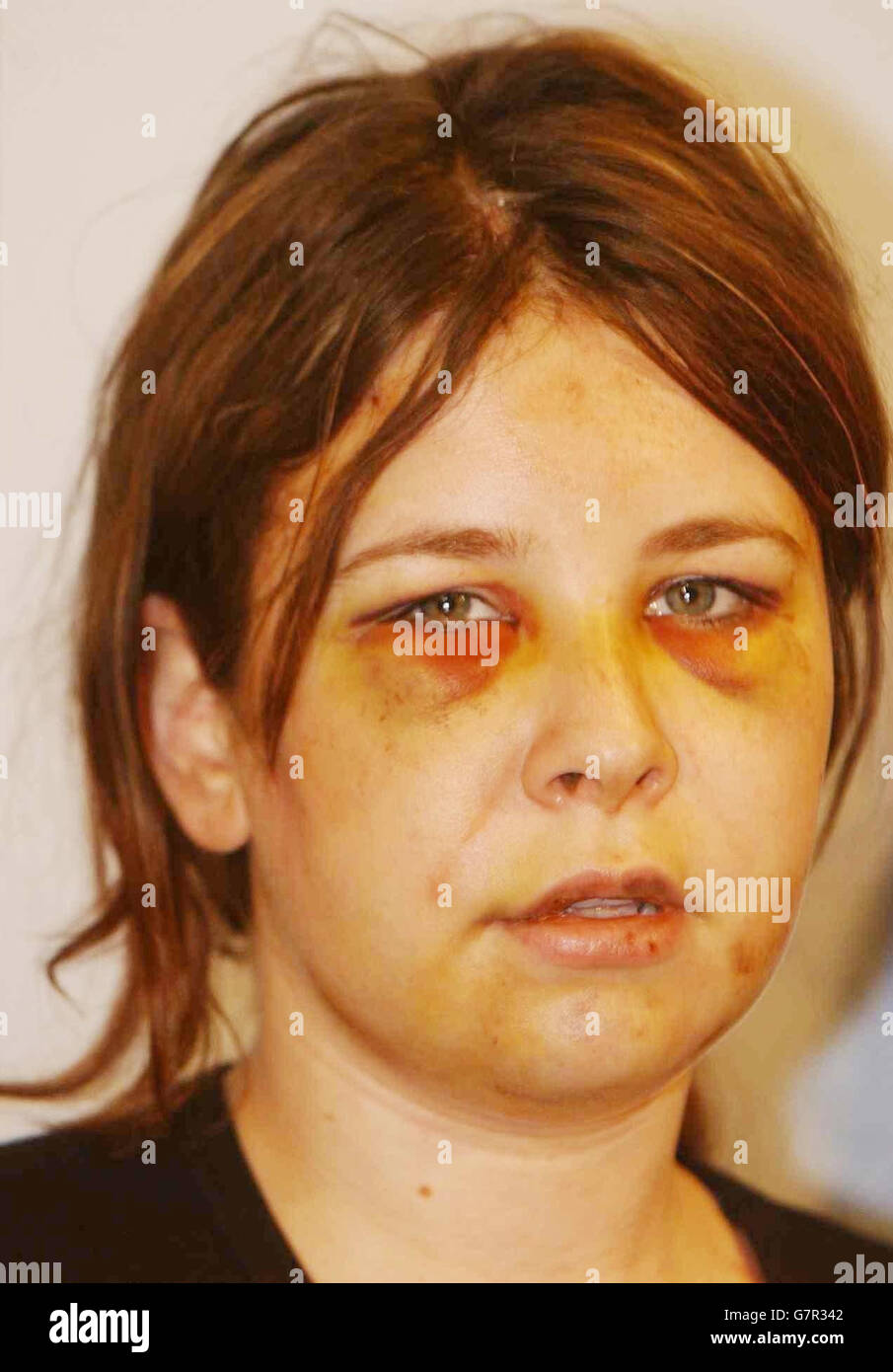 Restaurant manager Rachel Breward received severe head and face ...