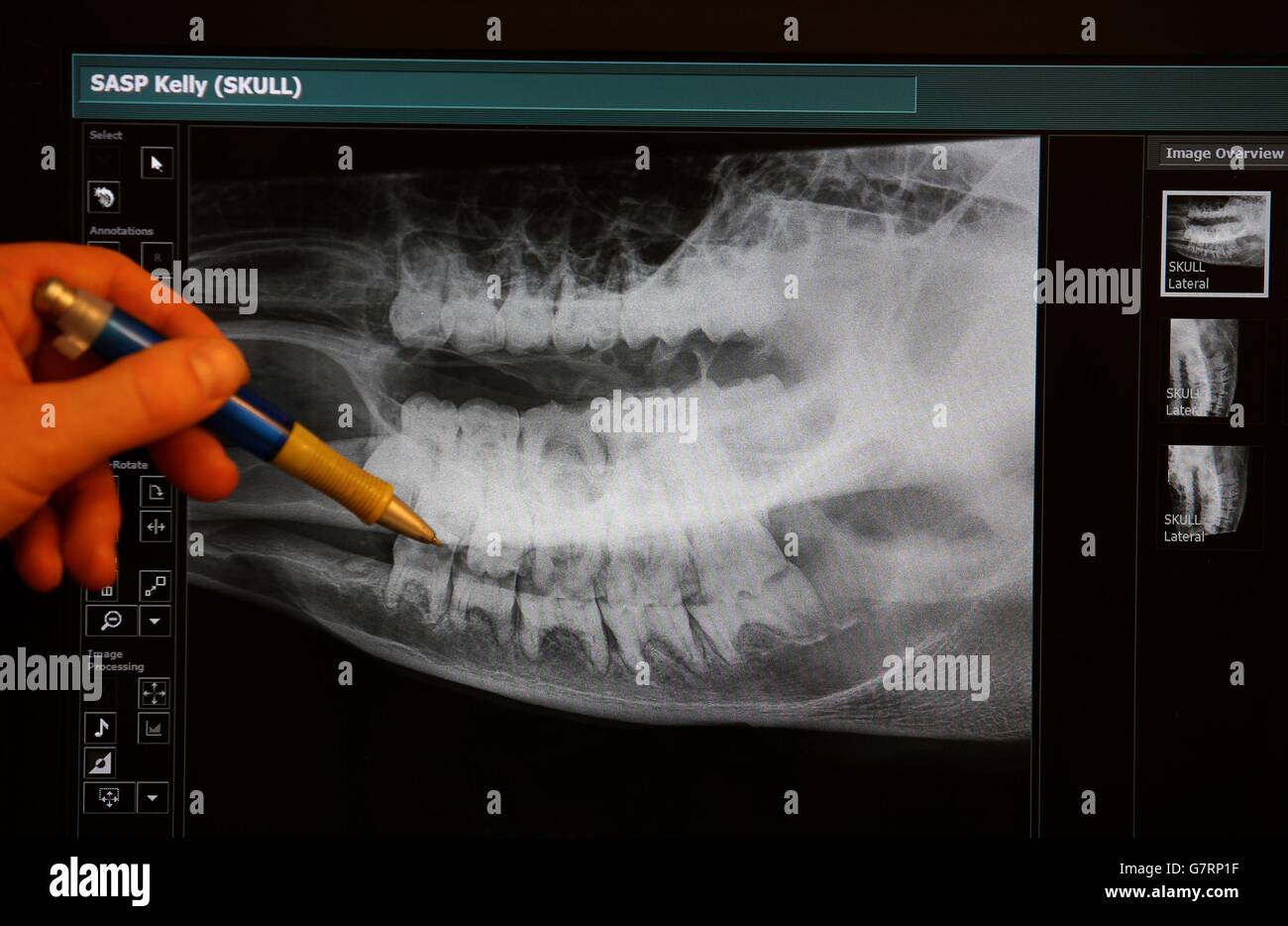 Giraffe jaw x ray hi-res stock photography and images - Alamy