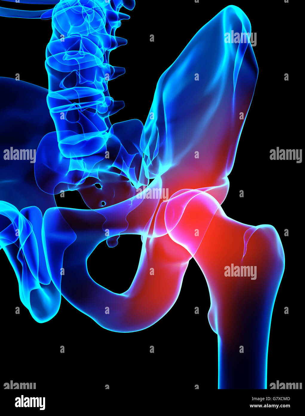 Hip replacement concept hi-res stock photography and images - Alamy