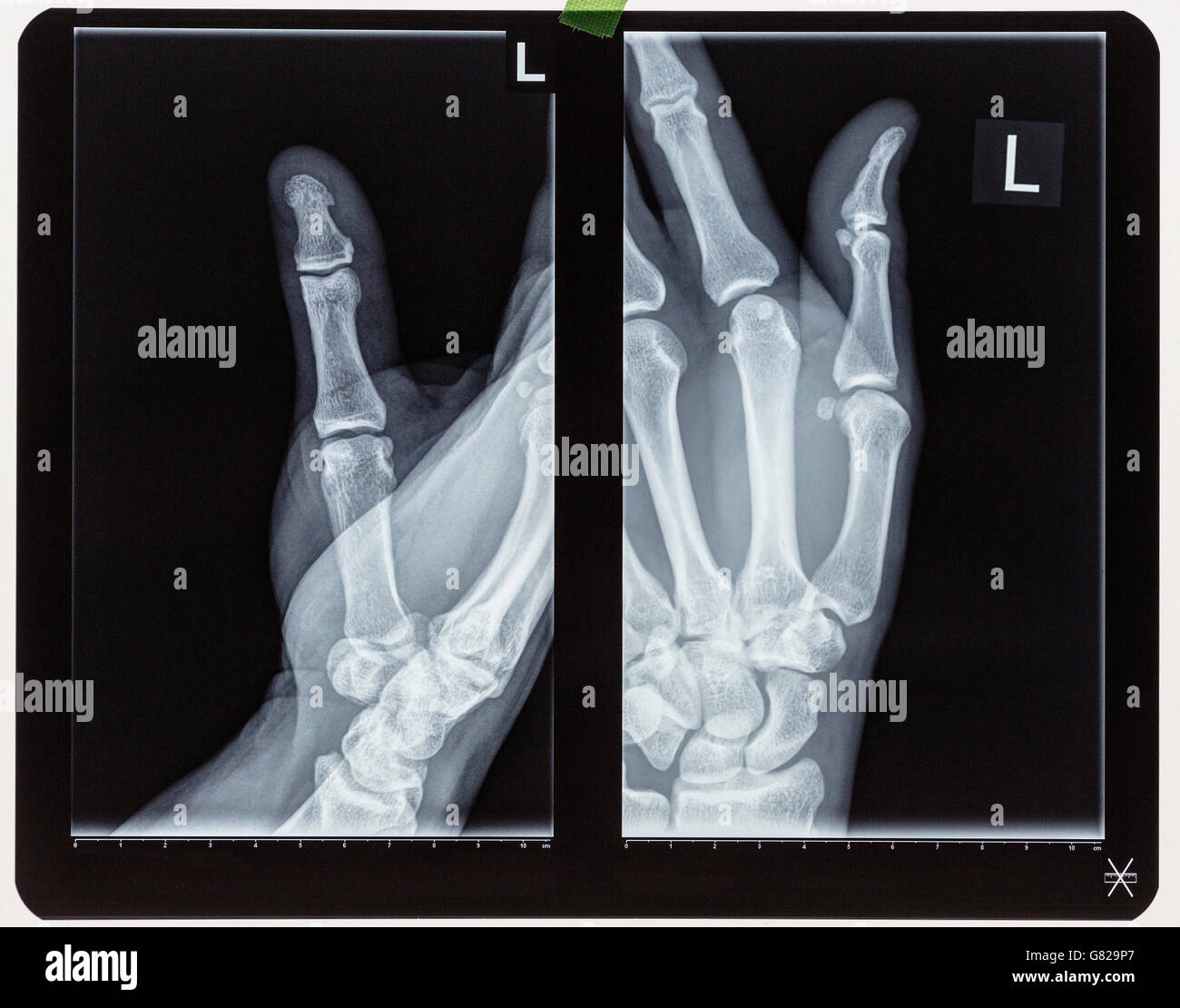 X-ray image of human hand Stock Photo - Alamy