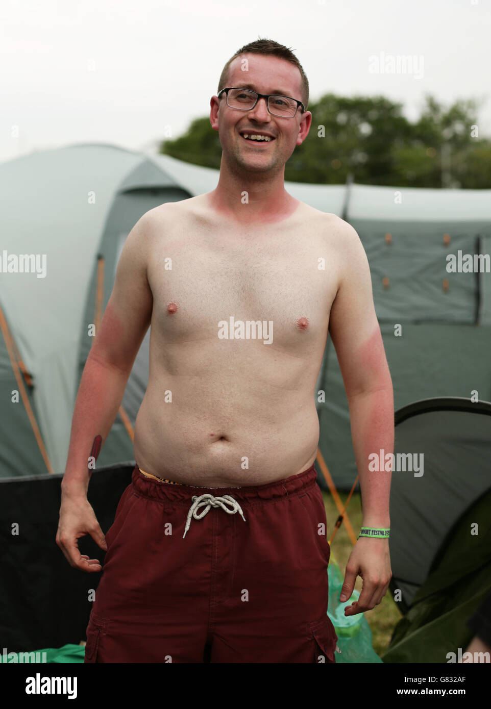 Sunburnt festivalgoer tom monk at the isle of wight festival hi-res ...