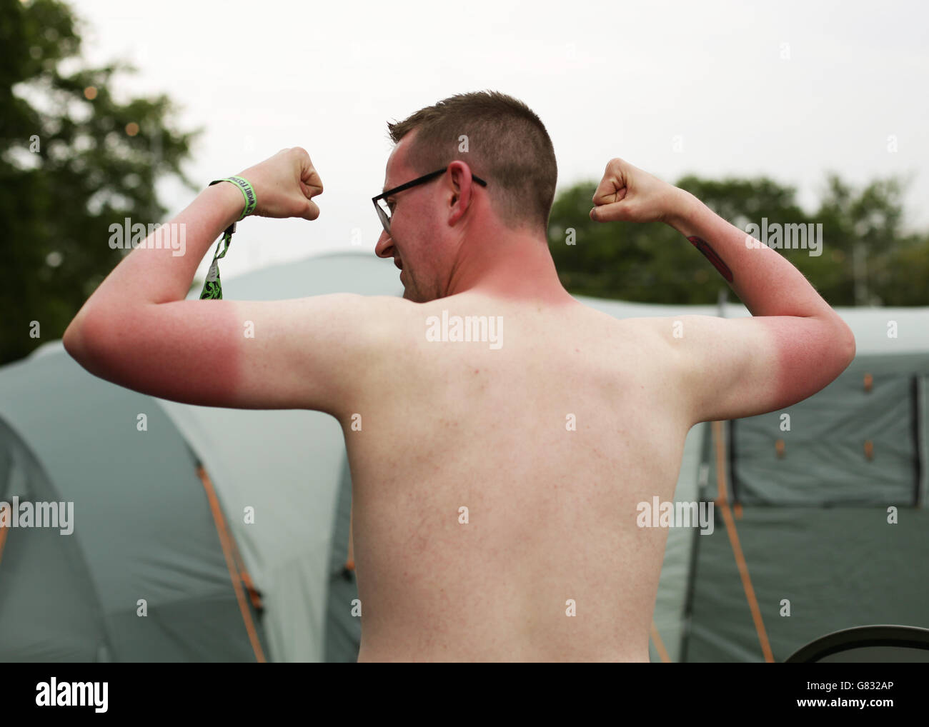 Sunburnt festivalgoer Tom Monk at the Isle of Wight Festival, in ...