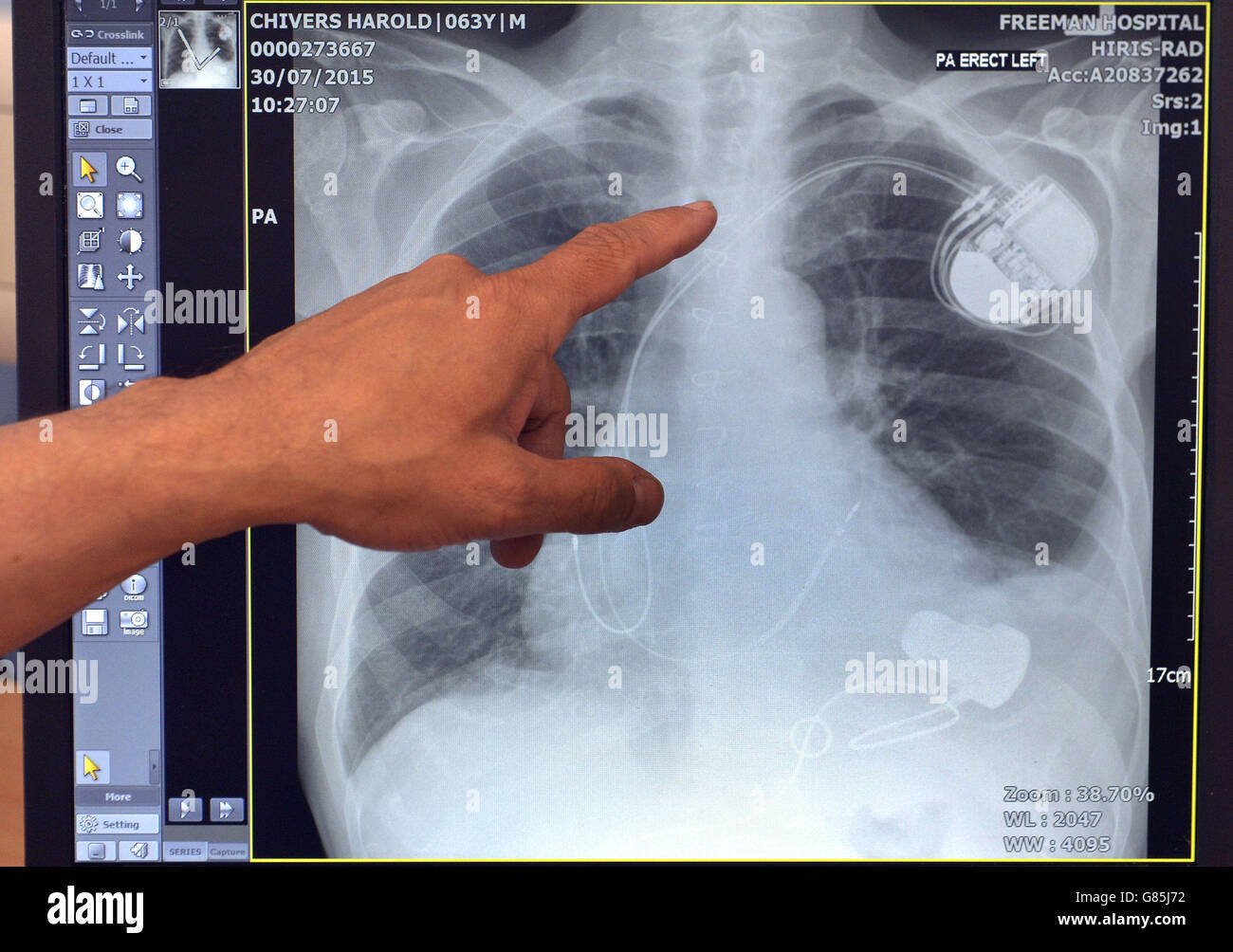 Ventricular assist device hi-res stock photography and images - Alamy