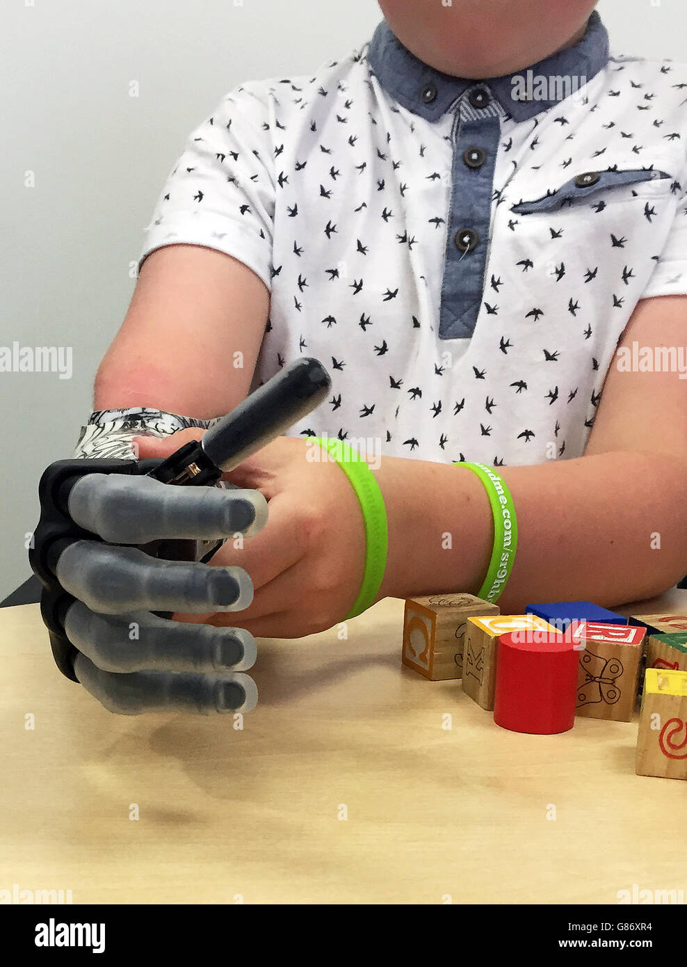 Who become first boy in uk fitted child sized bionic hand hi-res stock ...