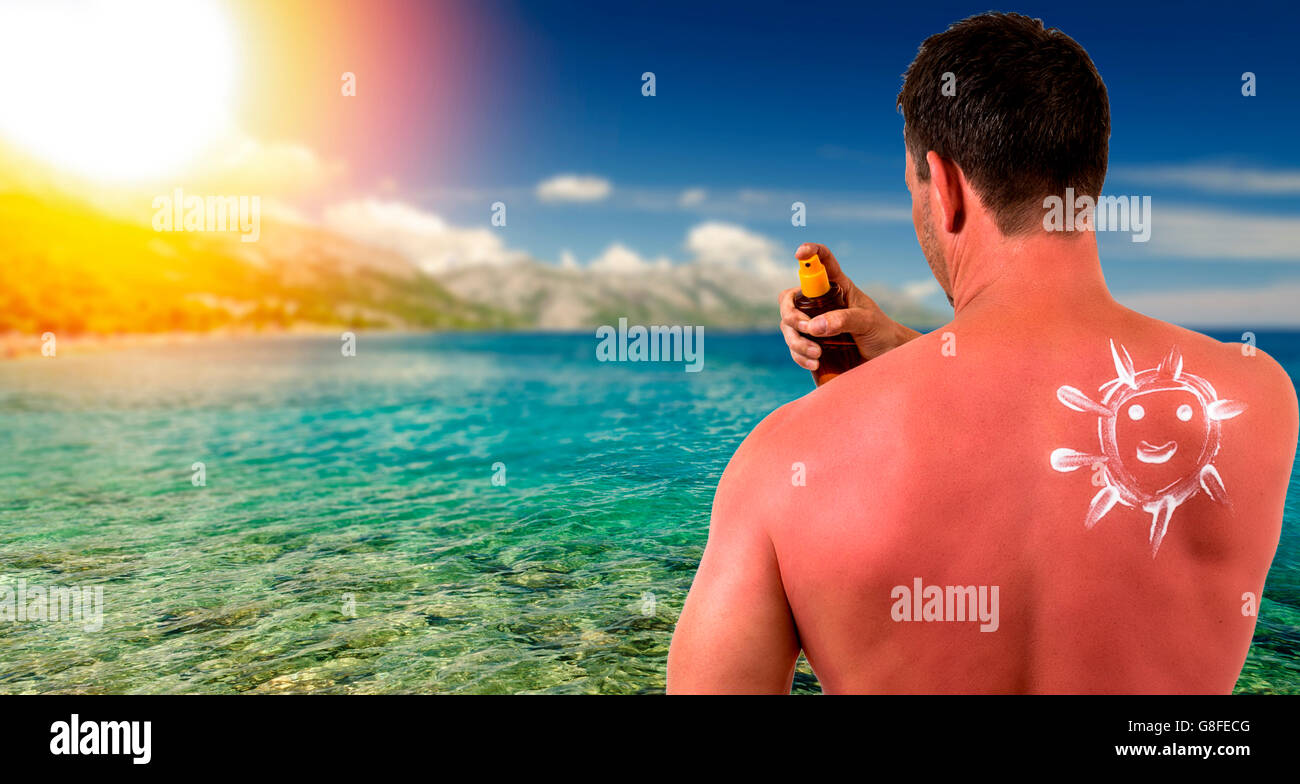 Red skin sunburn beach hi-res stock photography and images - Alamy