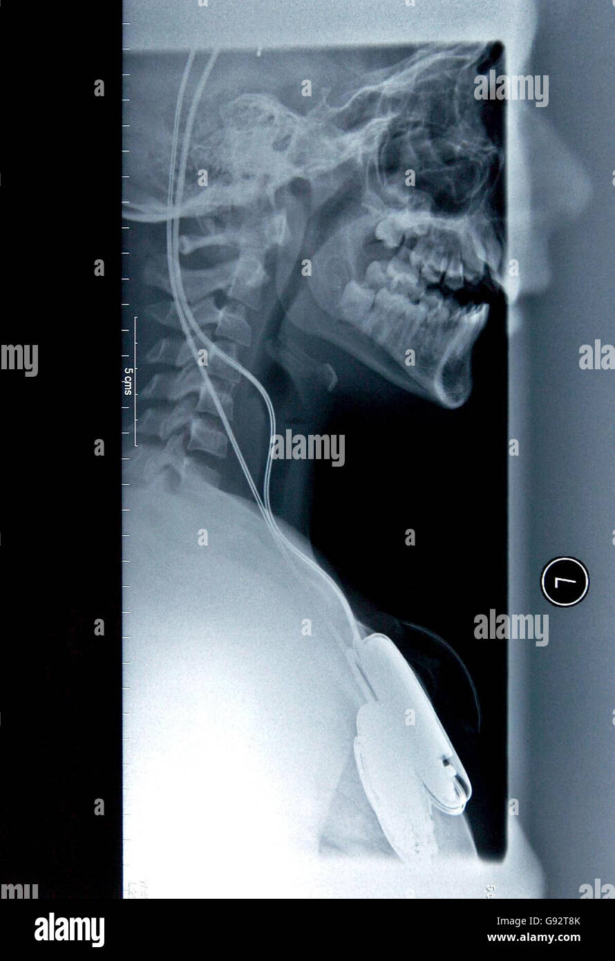 Electrodes implanted in the brain hi-res stock photography and images ...