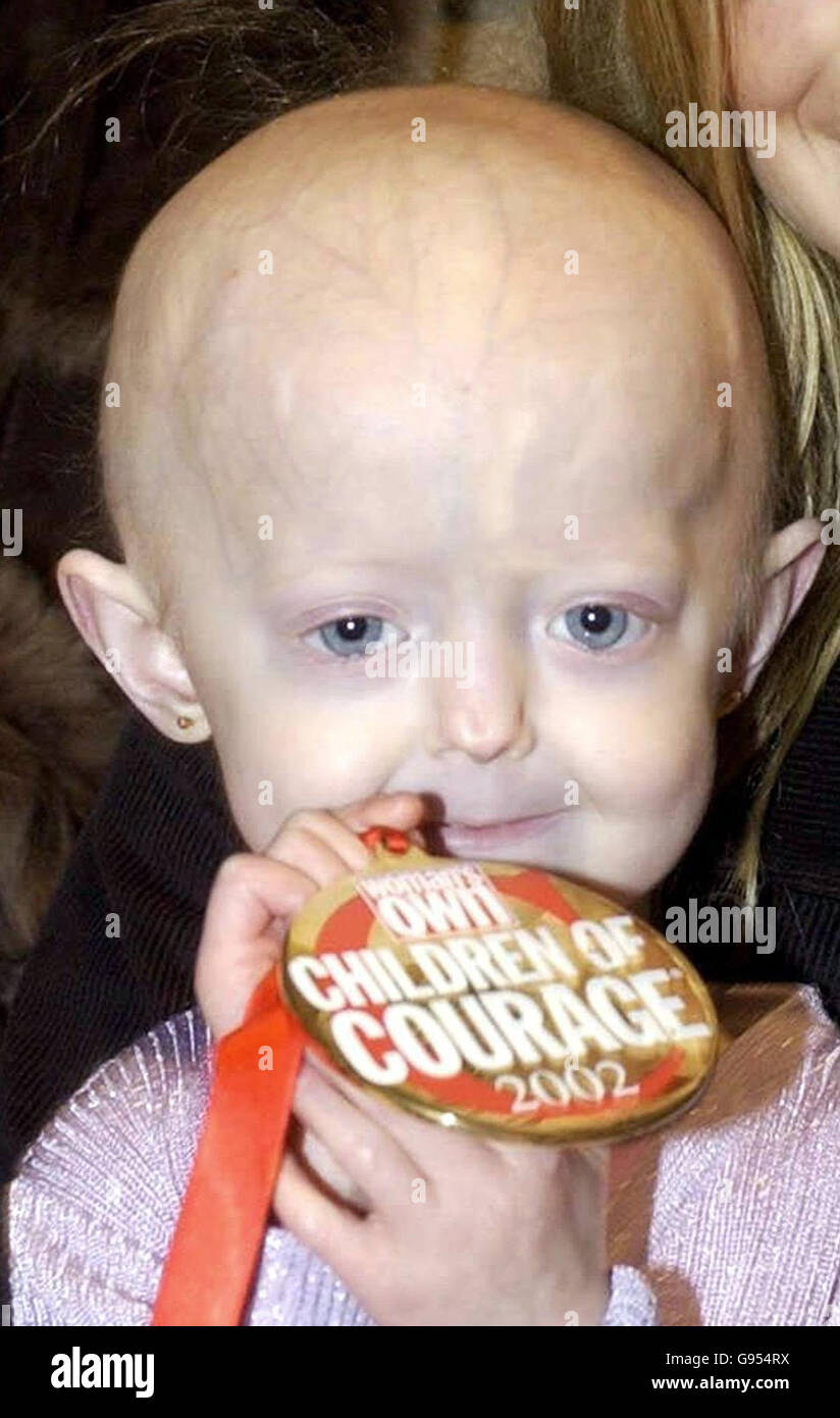 Progeria hi-res stock photography and images - Alamy