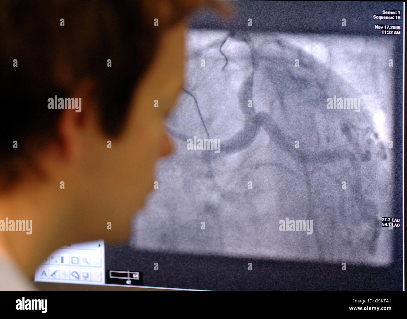 Arteries angiogram hi-res stock photography and images - Alamy