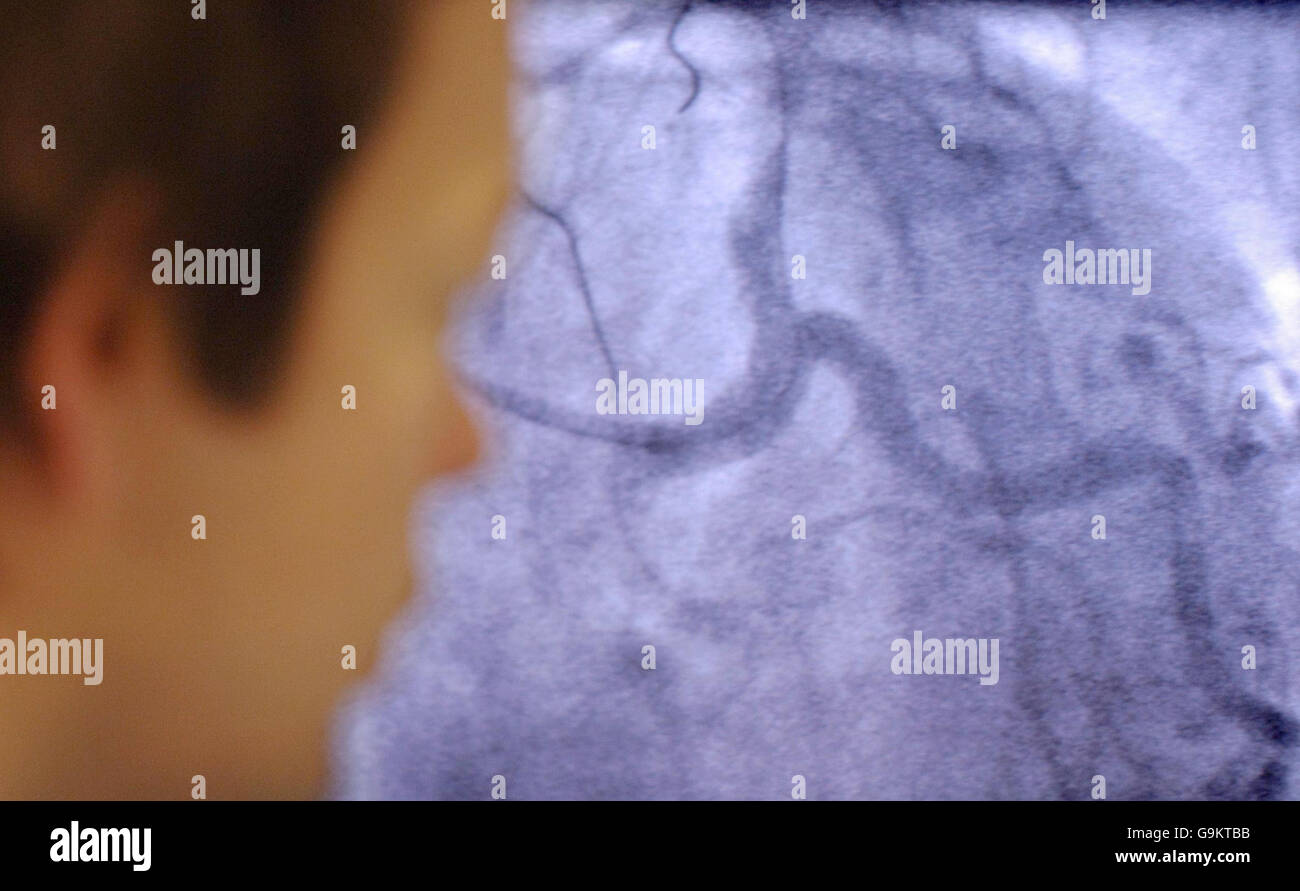 Generic stock image. Surgical monitor showing heart aeteries during ...