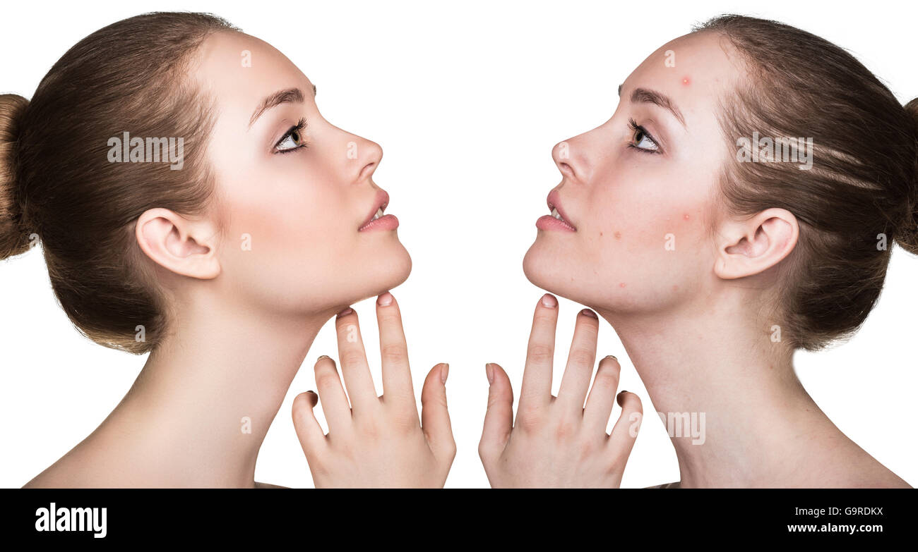 Comparison portrait of problematic skin Stock Photo - Alamy
