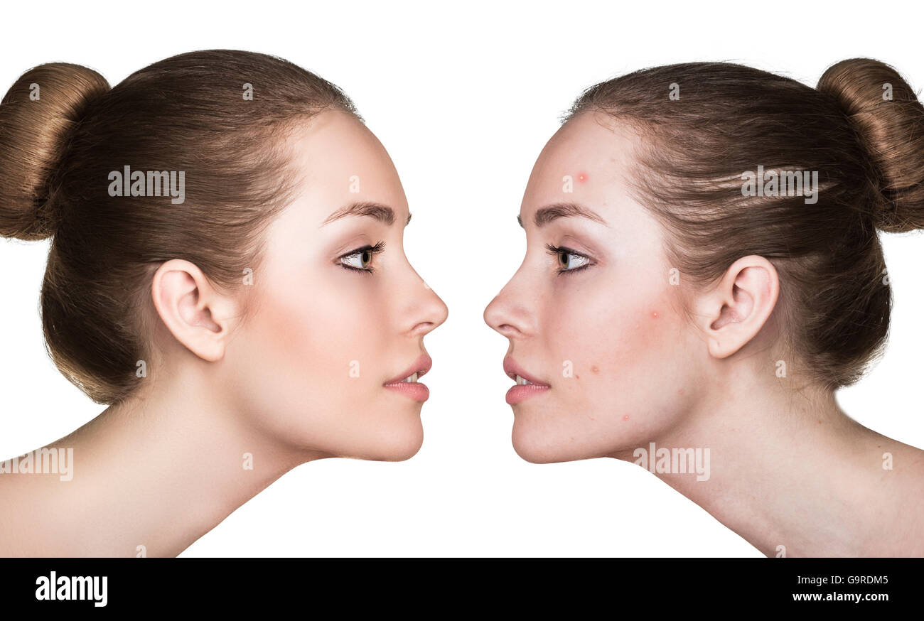 Comparison portrait of problematic skin Stock Photo - Alamy