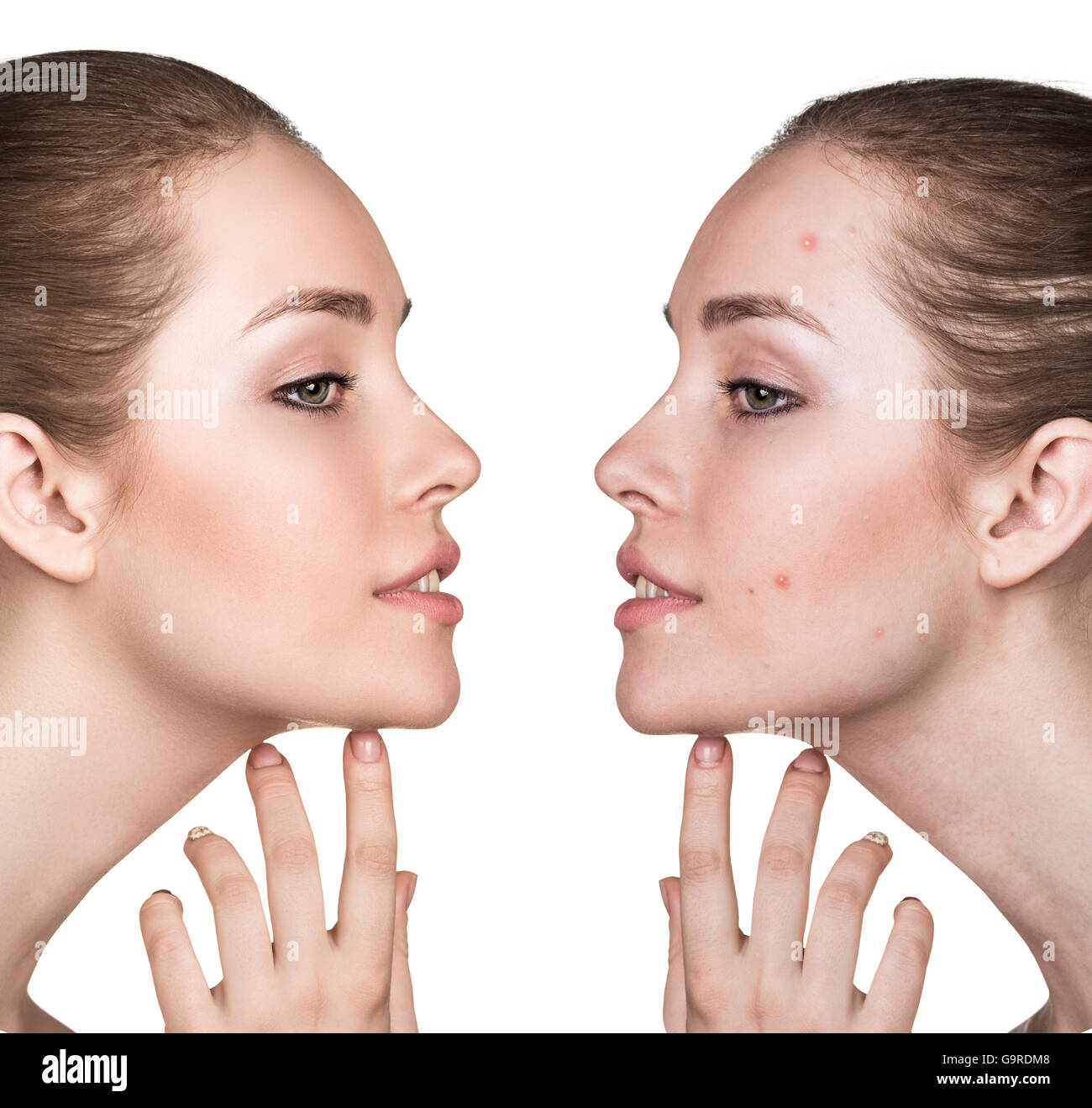 Comparison portrait of problematic skin Stock Photo - Alamy