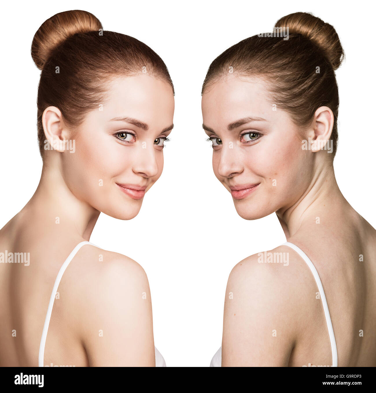 Comparison portrait of problematic skin Stock Photo - Alamy