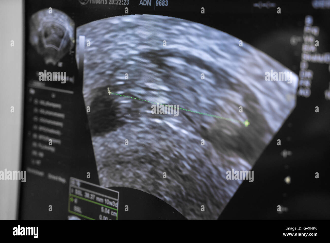 Obstetric Ultrasonography of unborn fetus Stock Photo - Alamy
