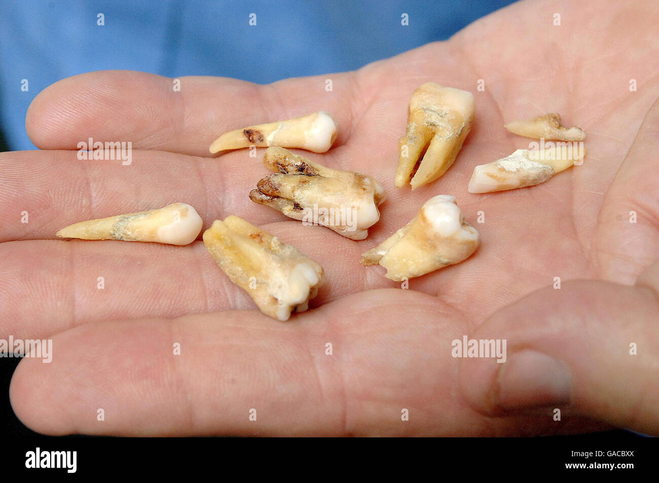 Pulled teeth hi-res stock photography and images - Alamy