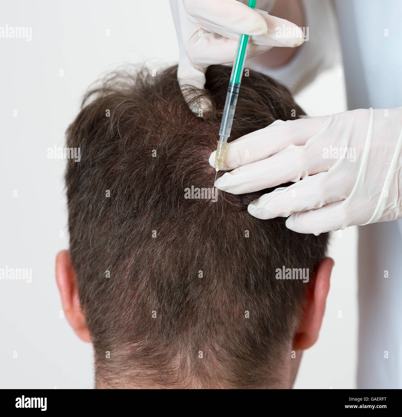 Handsome man is getting injection in head. Concept of Mesotherapy Stock ...