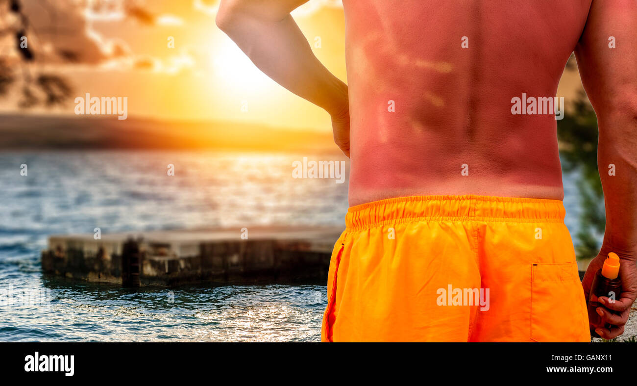 Man with sunburned skin and ocean beach with sunset Stock Photo - Alamy