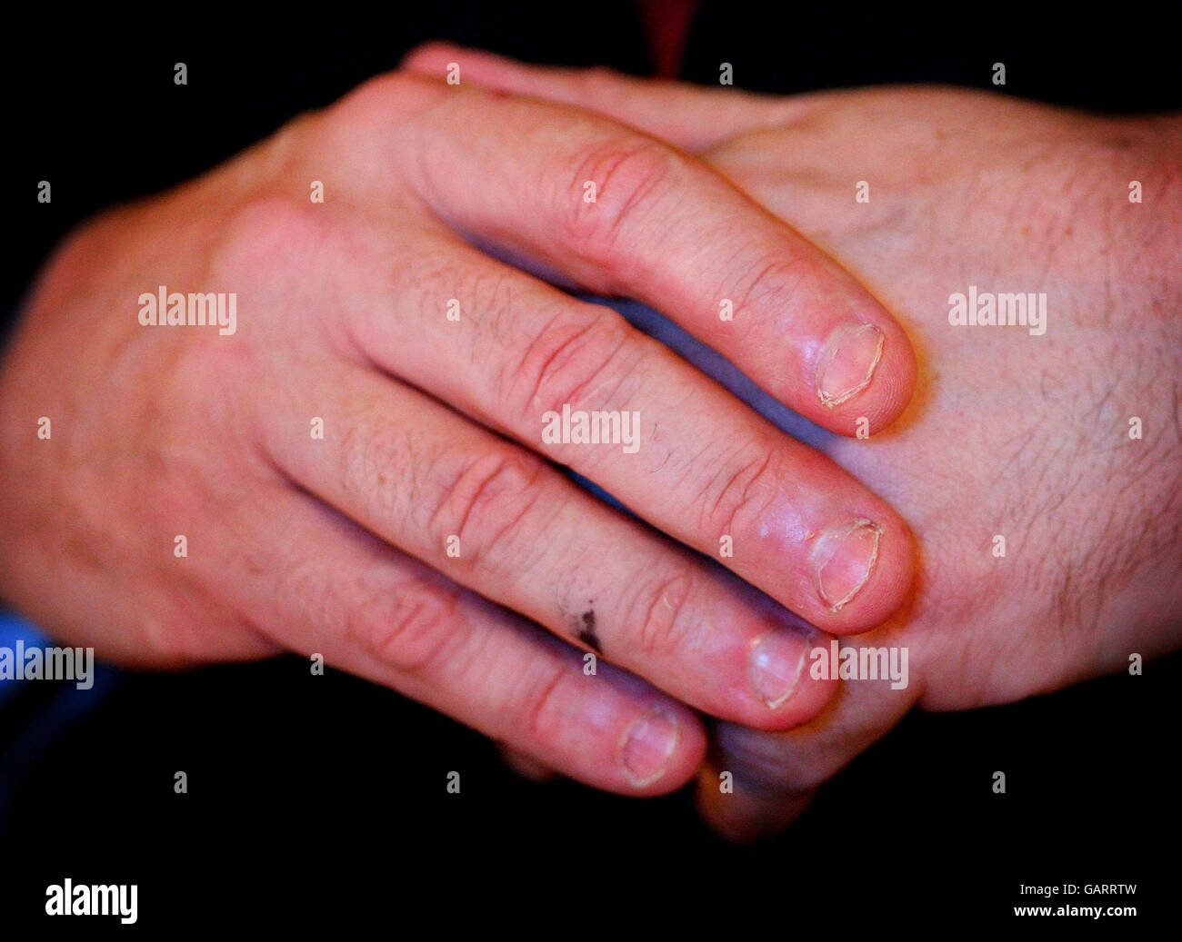 Bitten nails hi-res stock photography and images - Alamy