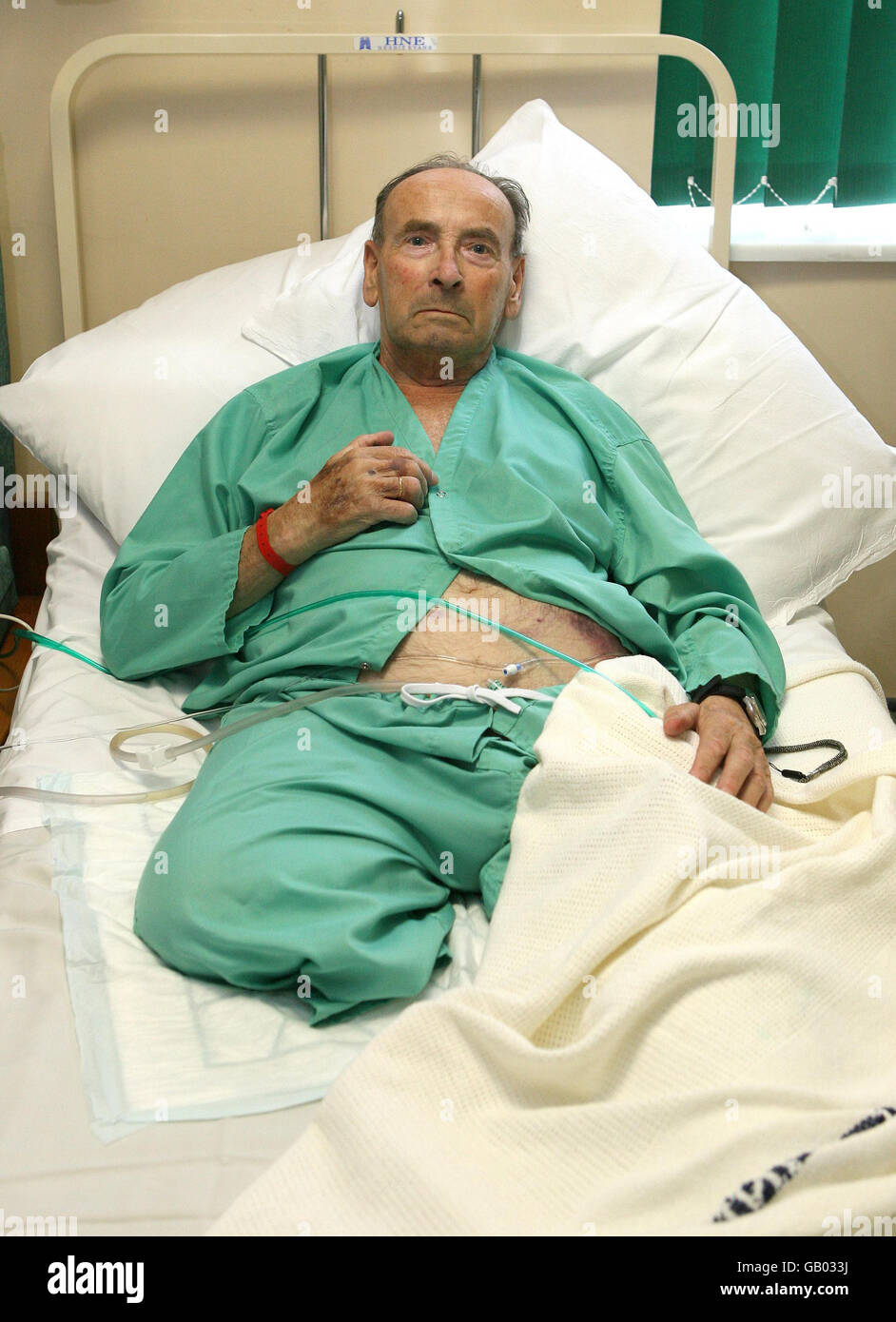 Man has leg amputated Stock Photo - Alamy