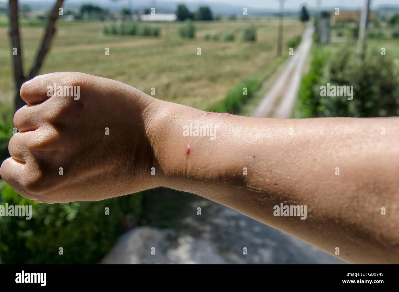 View of spider bite on a forearm Stock Photo - Alamy