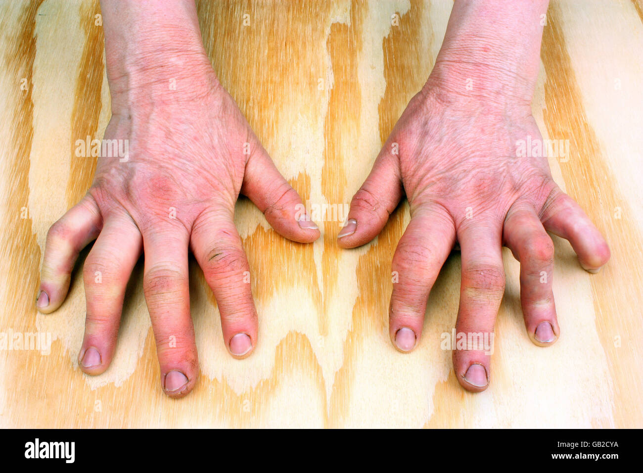Rheumatoid arthritis hand on a wooden table Stock Photo - Alamy