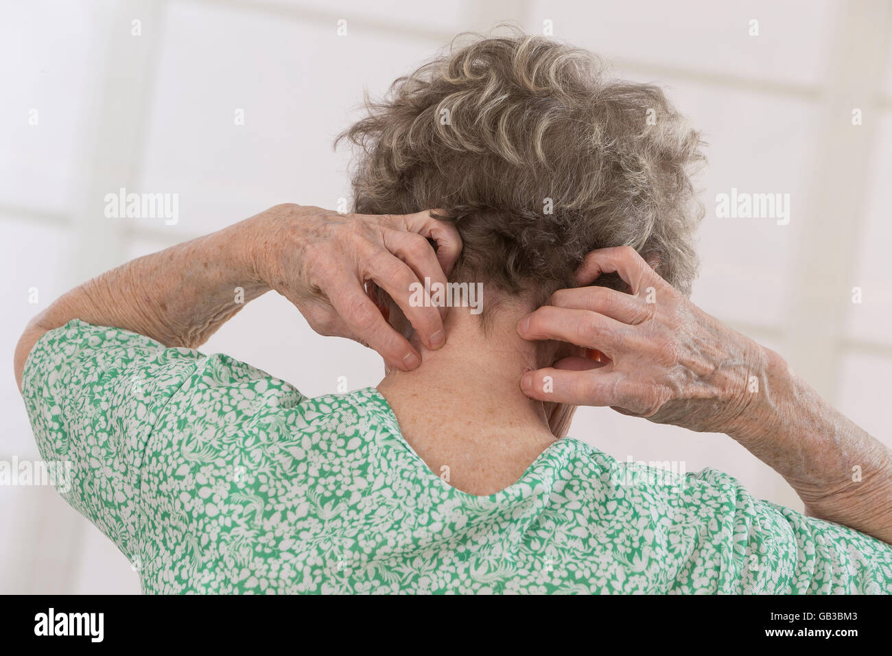 Psoriasis scalp hi-res stock photography and images - Alamy