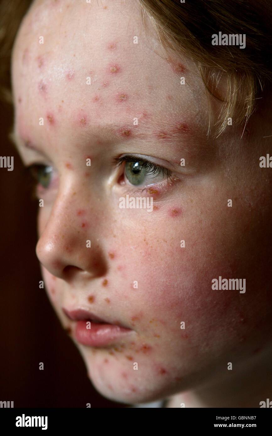 Pox image hi-res stock photography and images - Alamy