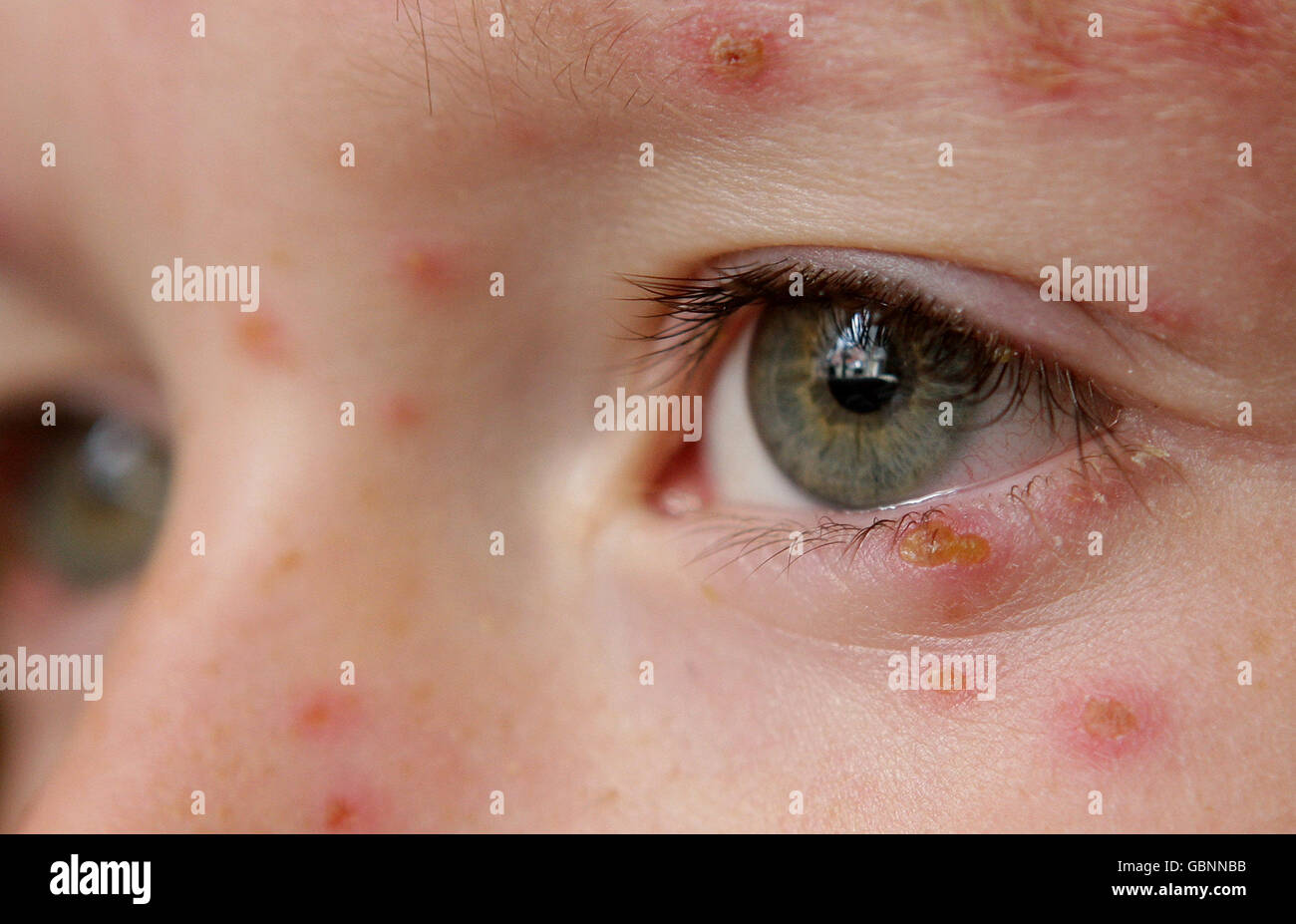 Chicken pox. STOCK. A child with chicken pox Stock Photo - Alamy