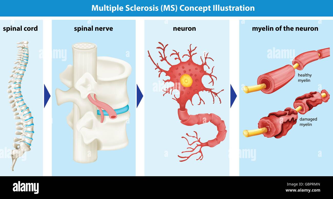Diagram showing multiple sclerosis concept illustration Stock Vector ... Diagram showing multiple sclerosis concept illustration Stock Vector ...