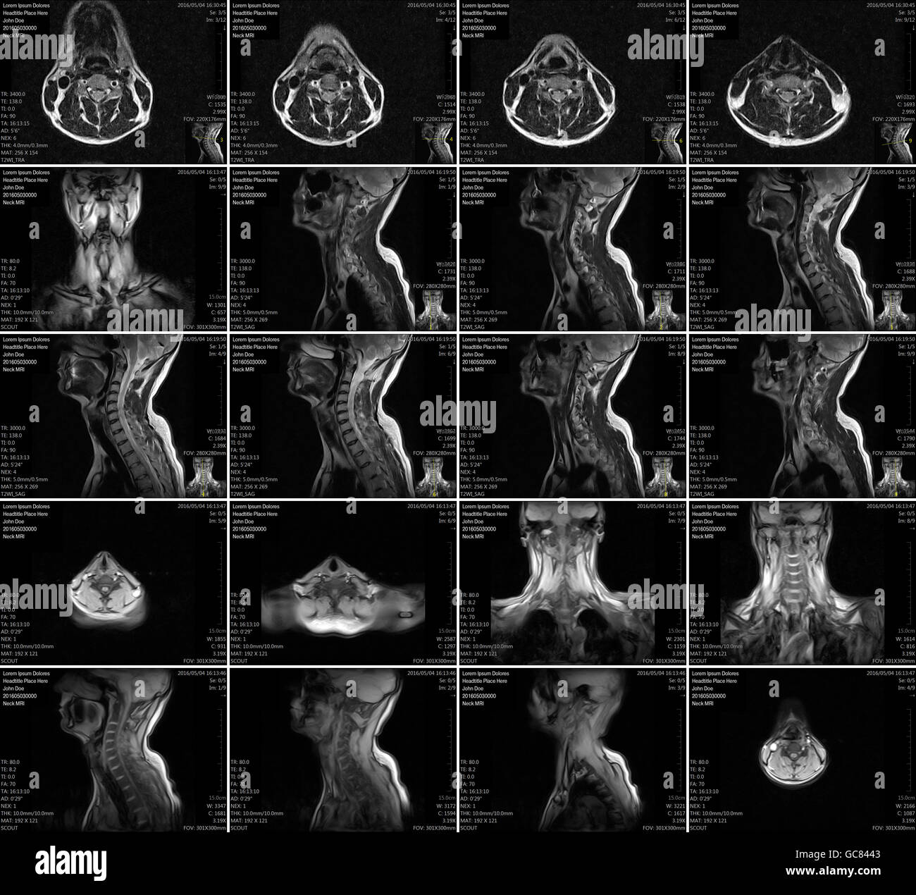 Human head neck mri hi-res stock photography and images - Alamy
