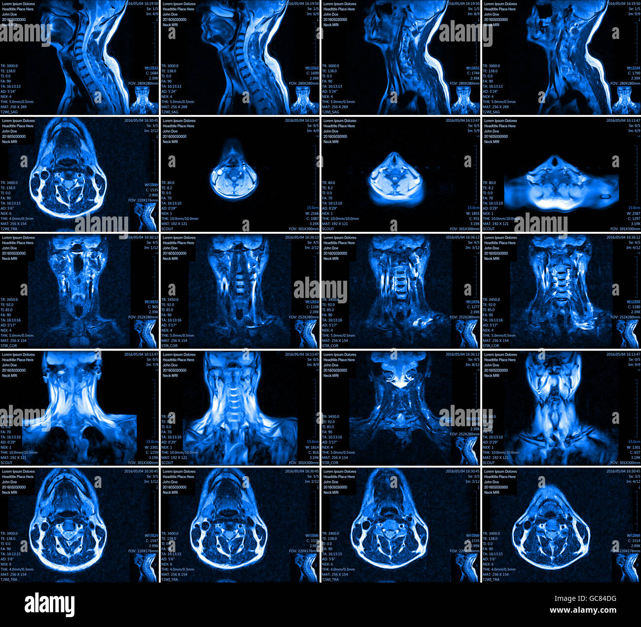 Ct human head neck scan hi-res stock photography and images - Alamy
