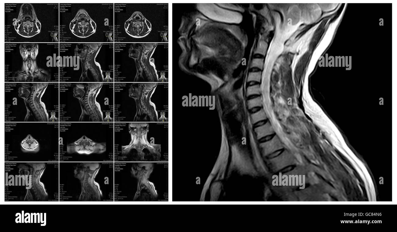 Ct of the cervical spine hi-res stock photography and images - Alamy