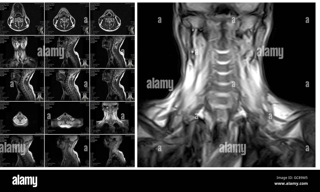 Magnetic resonance imaging of the cervical spine Stock Photo: 110821317 ...