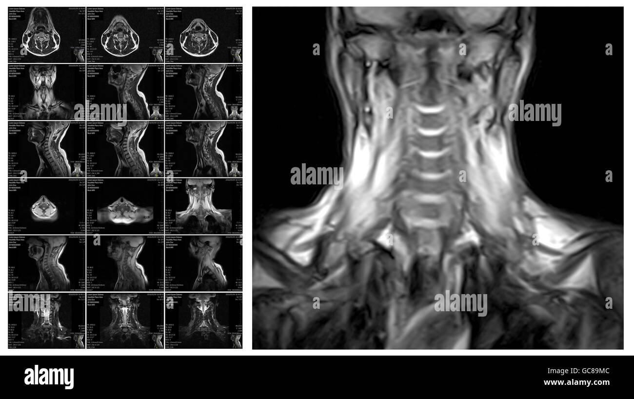 Human head neck mri Black and White Stock Photos & Images - Alamy