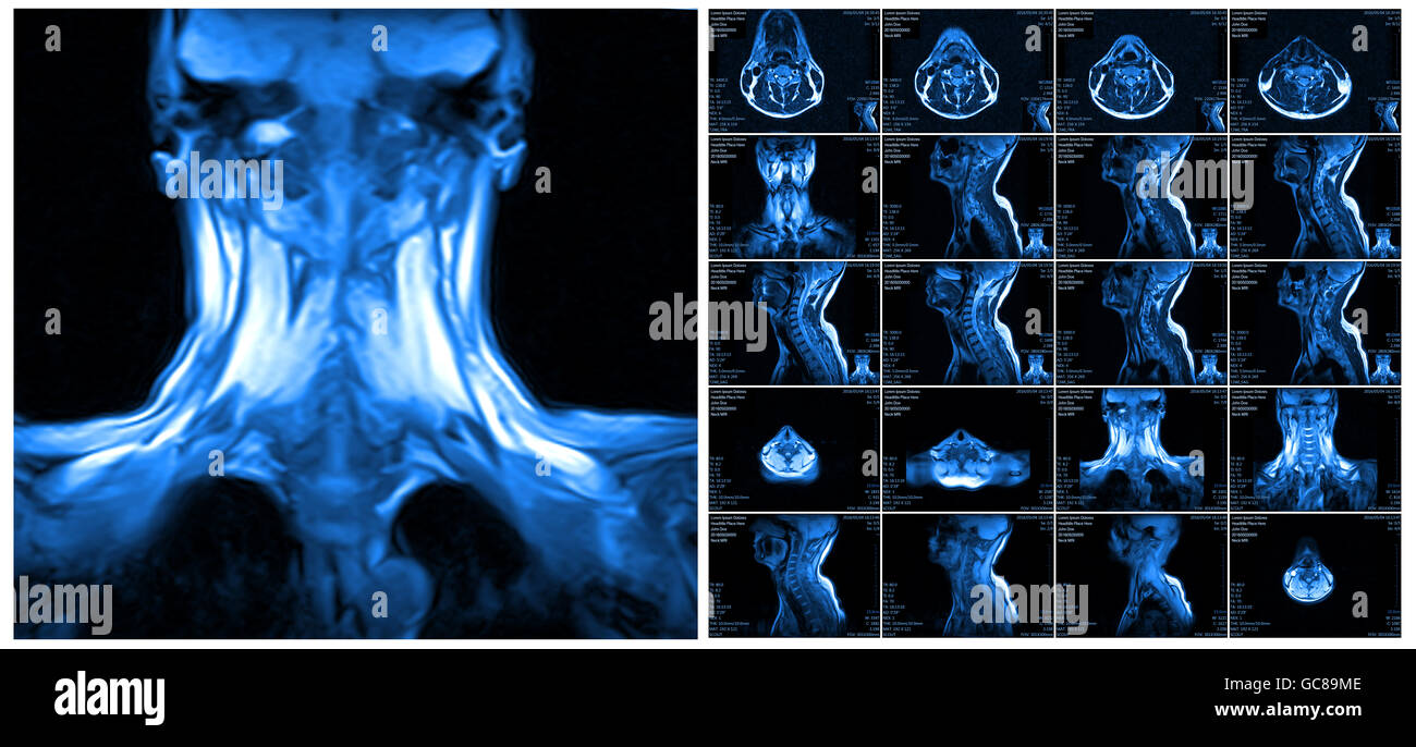 Mri Neck Spine Stock Photos & Mri Neck Spine Stock Images - Alamy