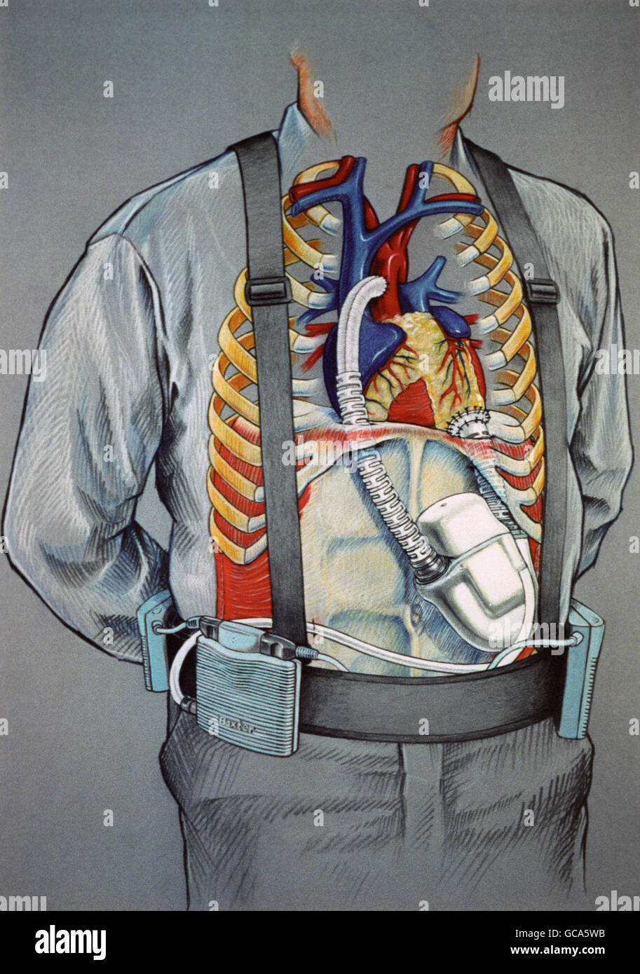 Ventricular assist device hi-res stock photography and images - Alamy