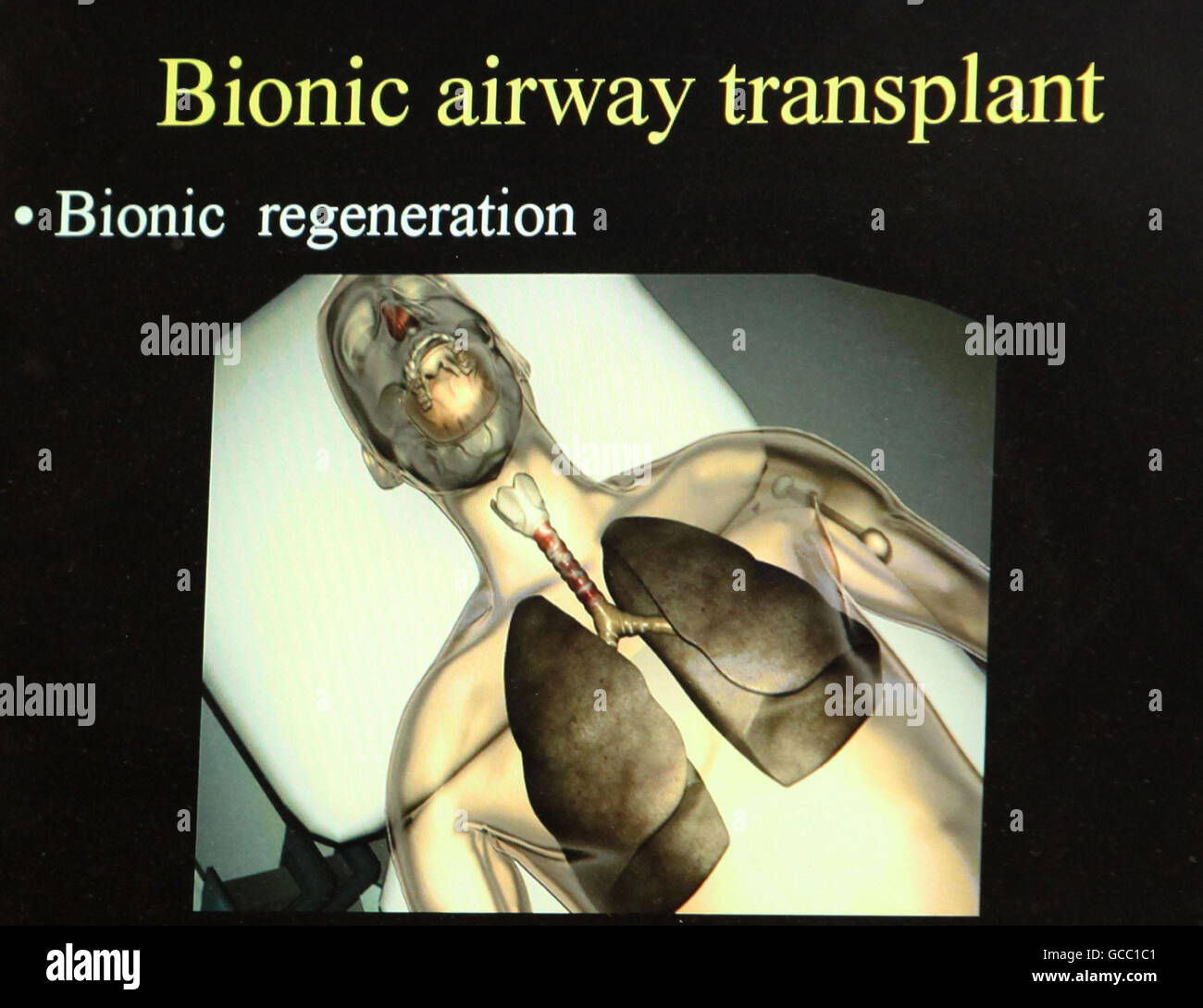 Trachea transplant operation Stock Photo - Alamy