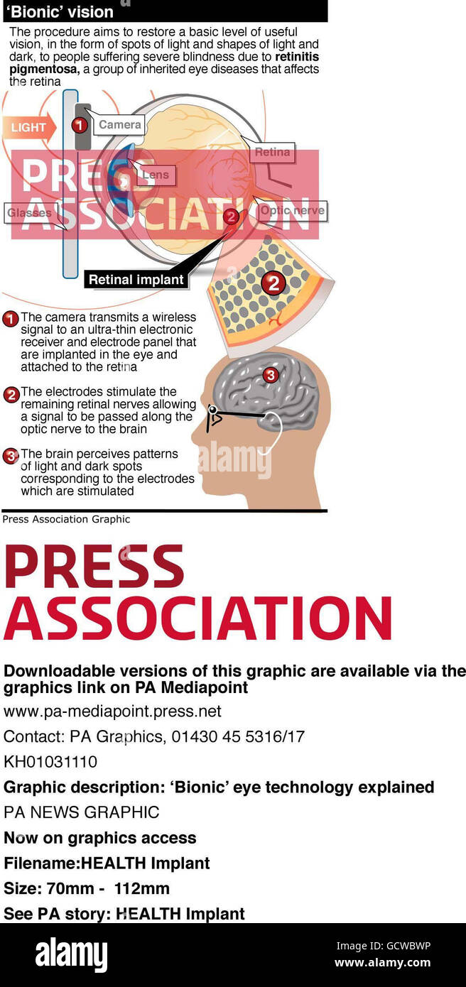 Bionic eye technology explained Stock Photo - Alamy