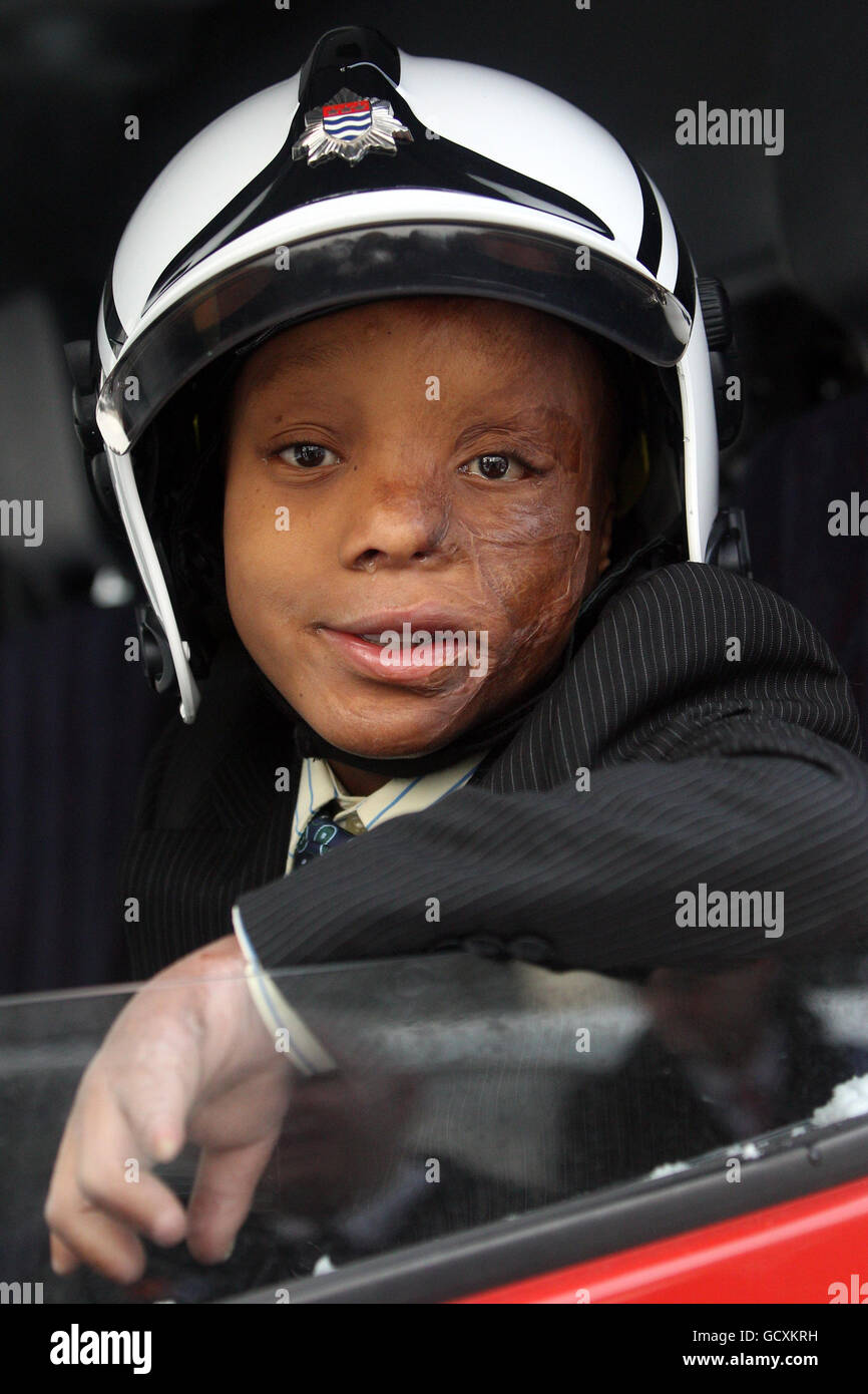 Burnt child hi-res stock photography and images - Alamy