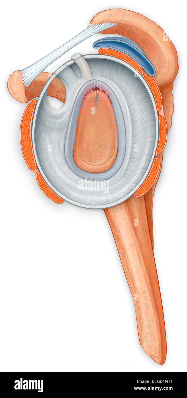Rotator cuff repair hi-res stock photography and images - Alamy