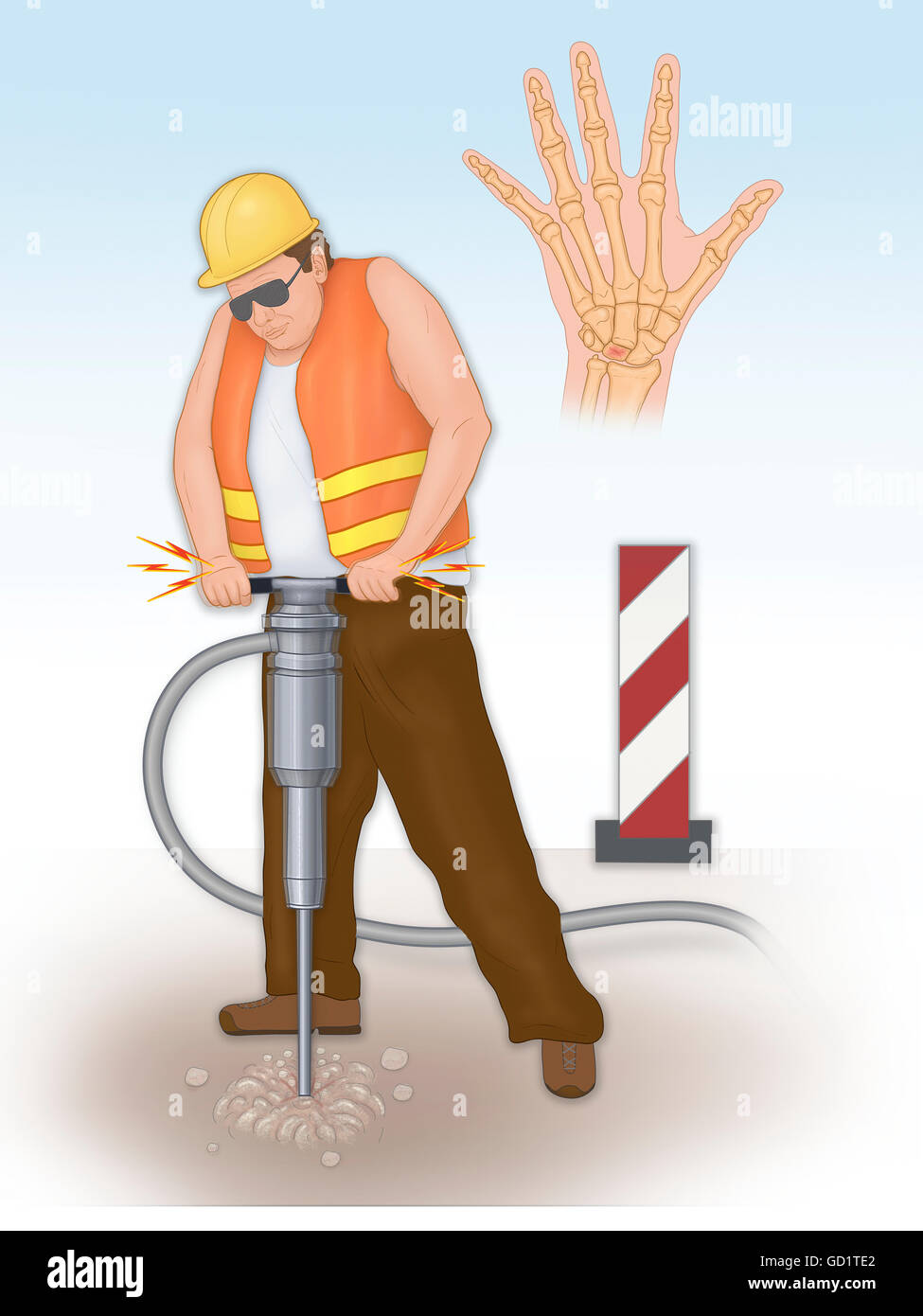 Kienbock's Disease Is Caused From Repetitive Microtrauma To The Wrist ...