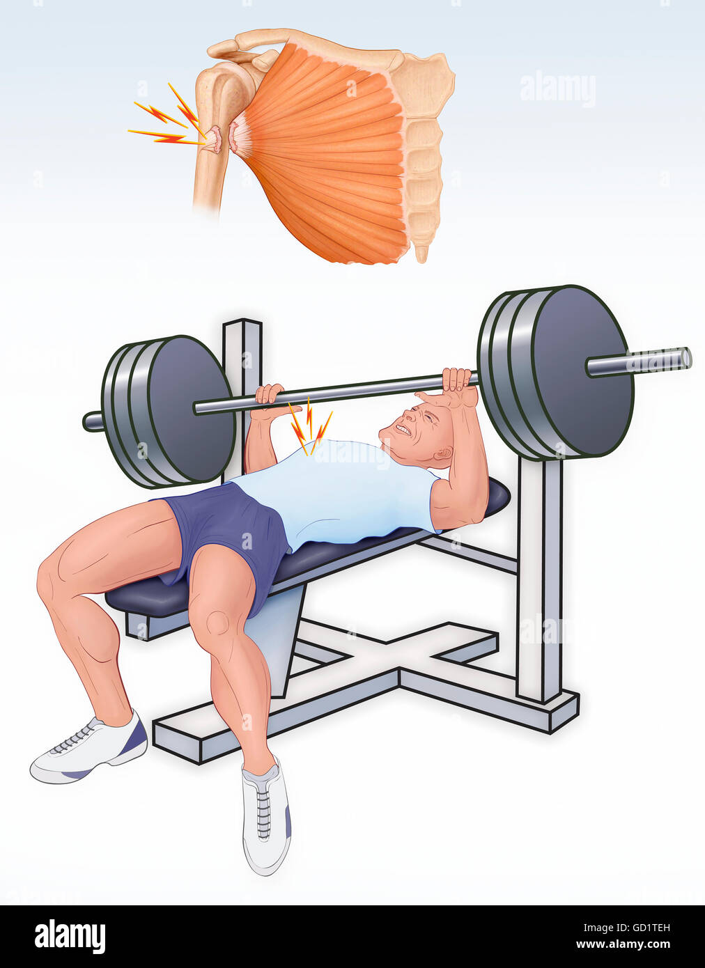 Muscle tear hi-res stock photography and images - Alamy