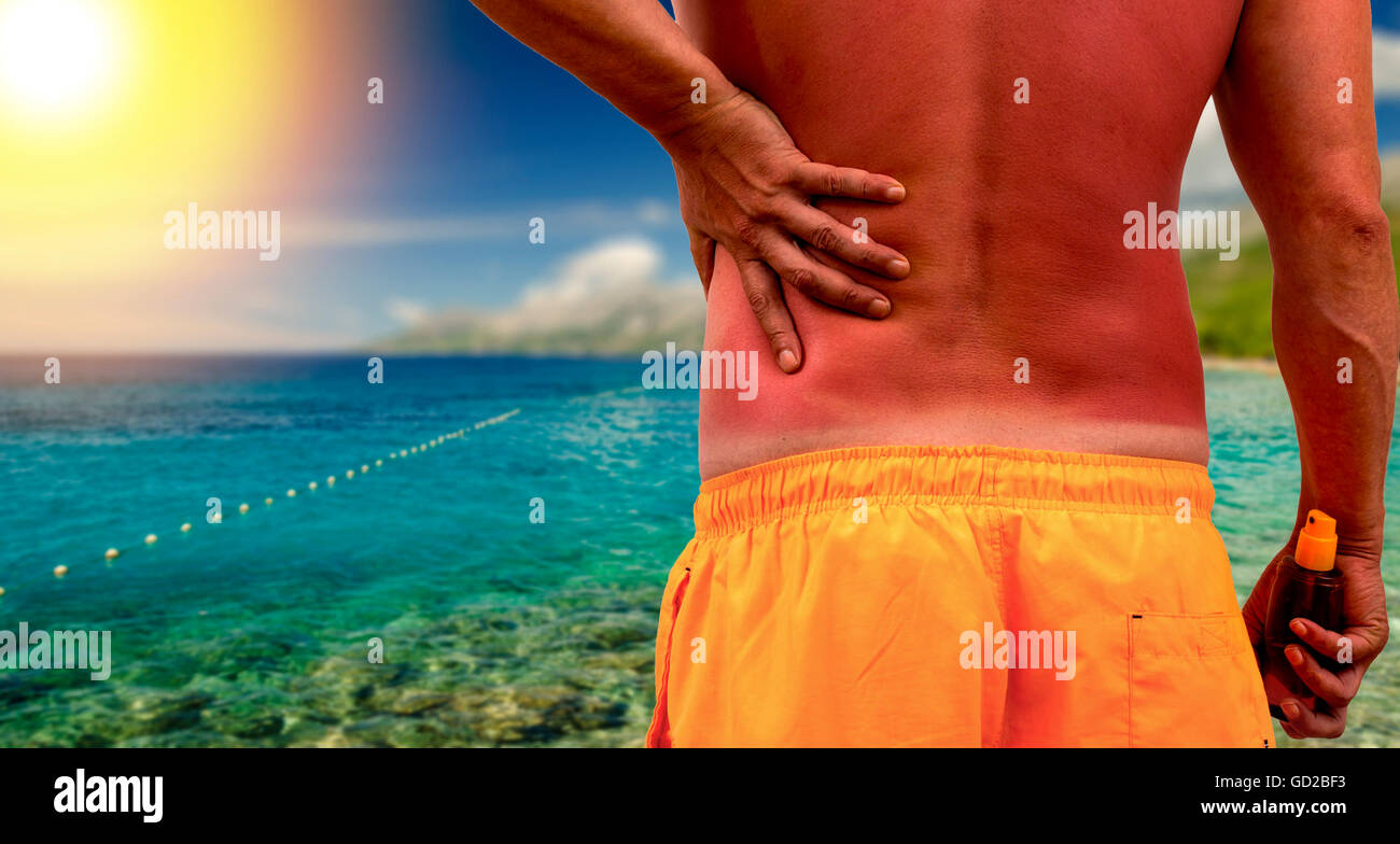 Man with sunburned skin and ocean beach with sunset Stock Photo - Alamy