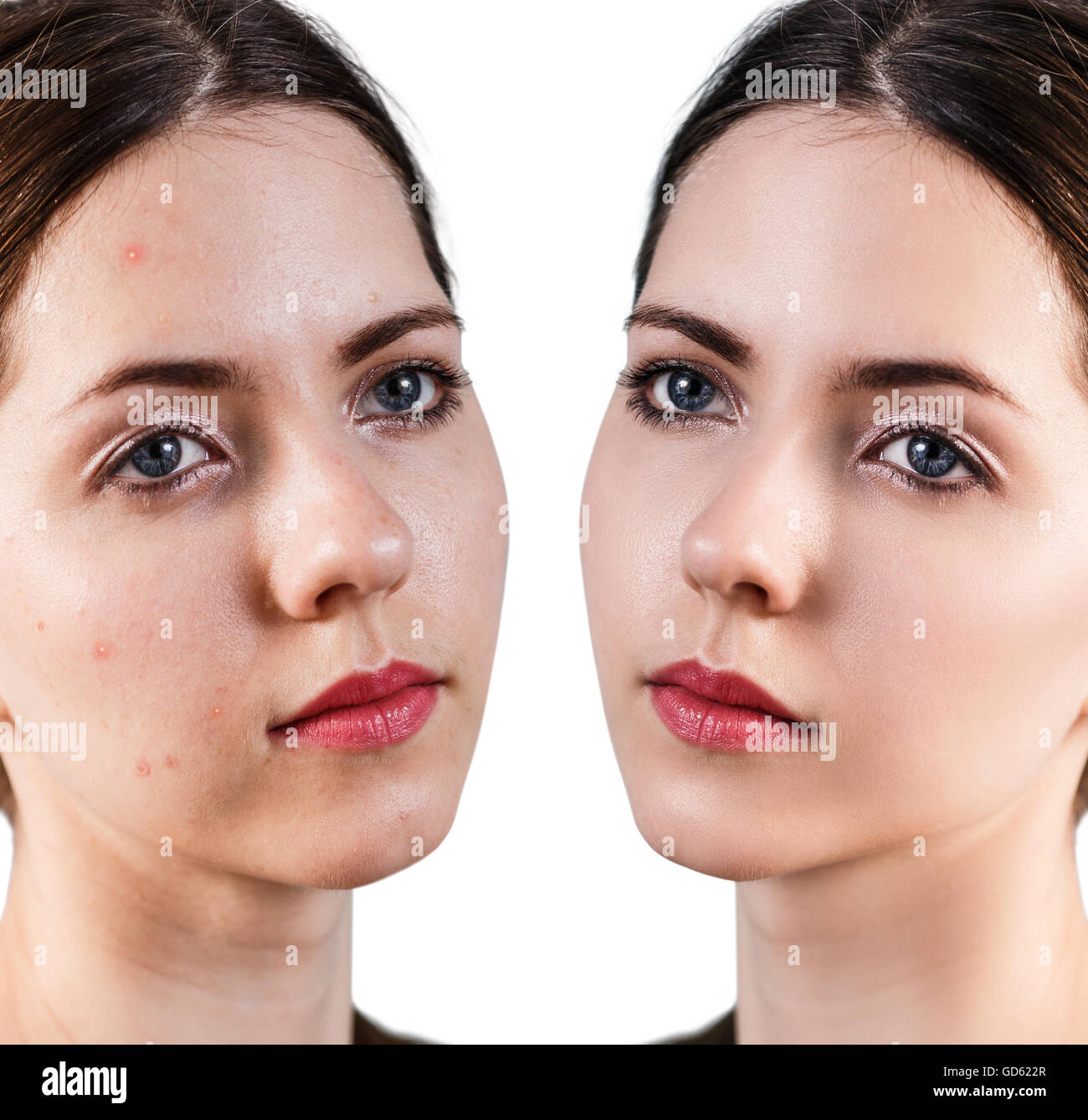 Face problem hi-res stock photography and images - Alamy