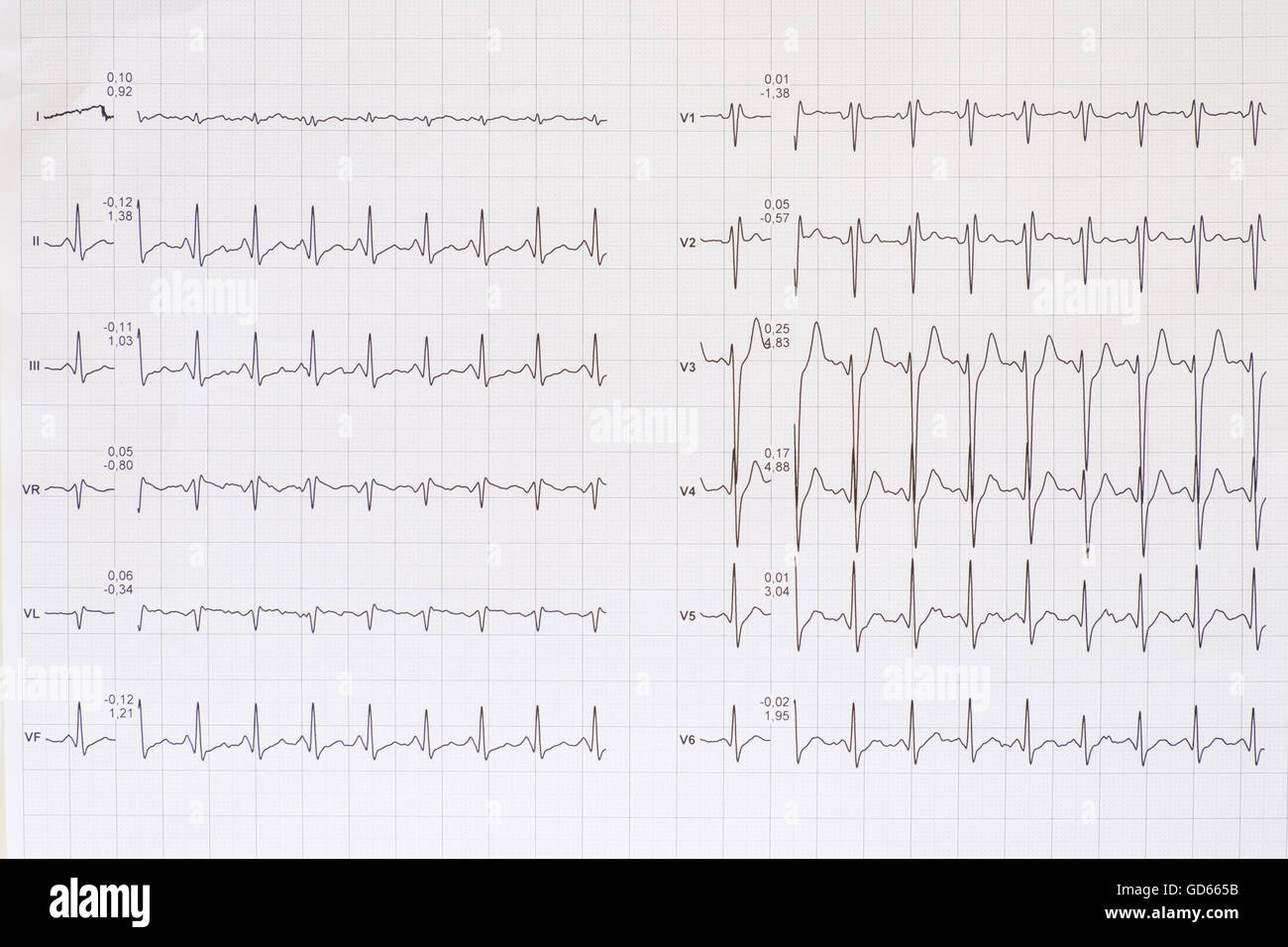 Heart attack ecg hi-res stock photography and images - Alamy
