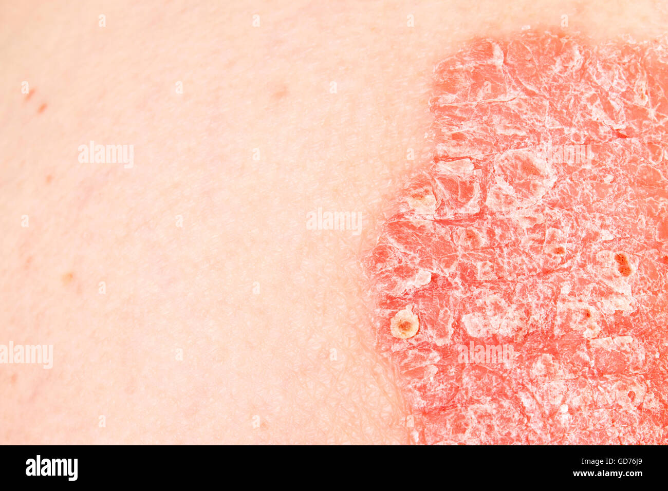 Psoriatic Skin High Resolution Stock Photography and Images - Alamy